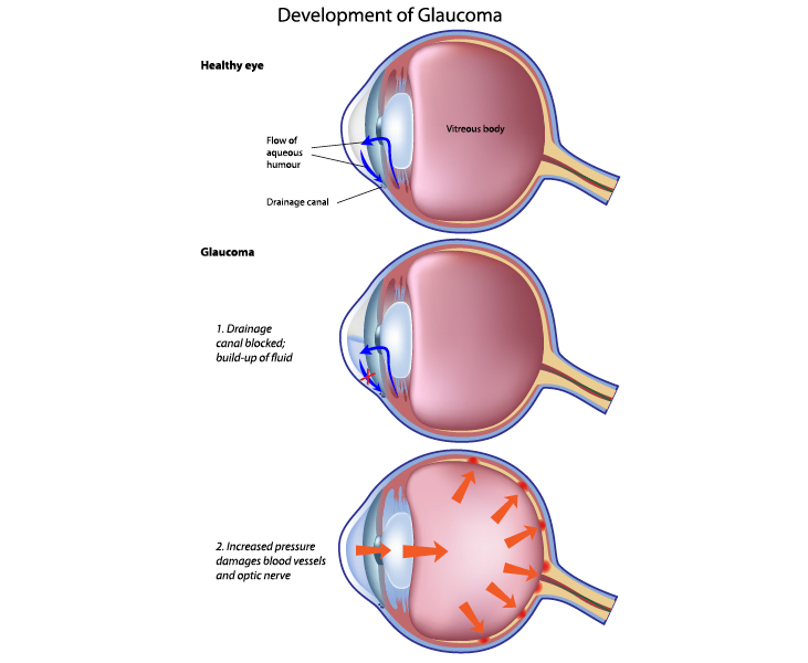 Glaucoma Medirex Opticians Glaucoma Medirex Opticians